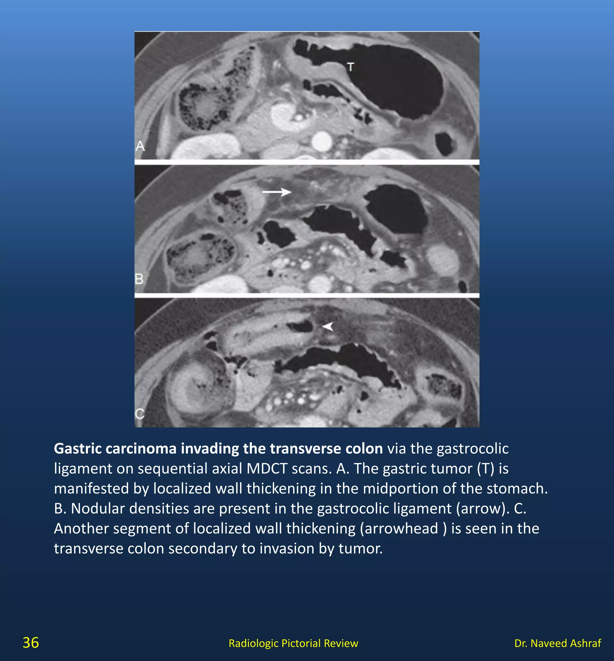 Carcinoma of Stomach | PDF
