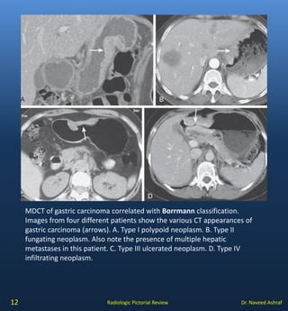 Carcinoma of Stomach | PDF