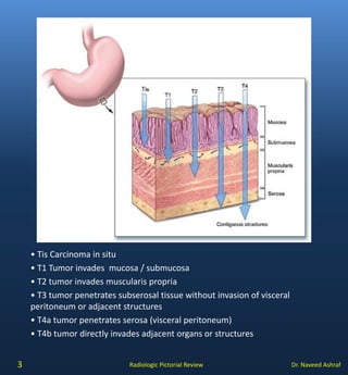 Carcinoma of Stomach | PDF