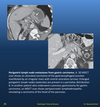Carcinoma of Stomach | PDF