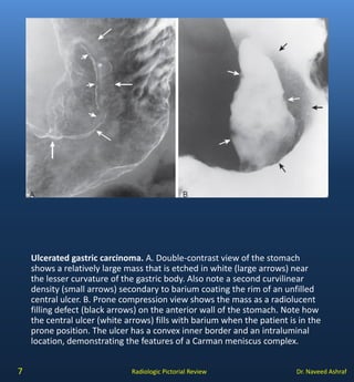 Carcinoma of Stomach | PDF
