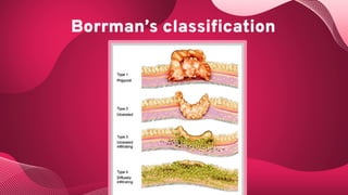 CA STOMACH.pptx
