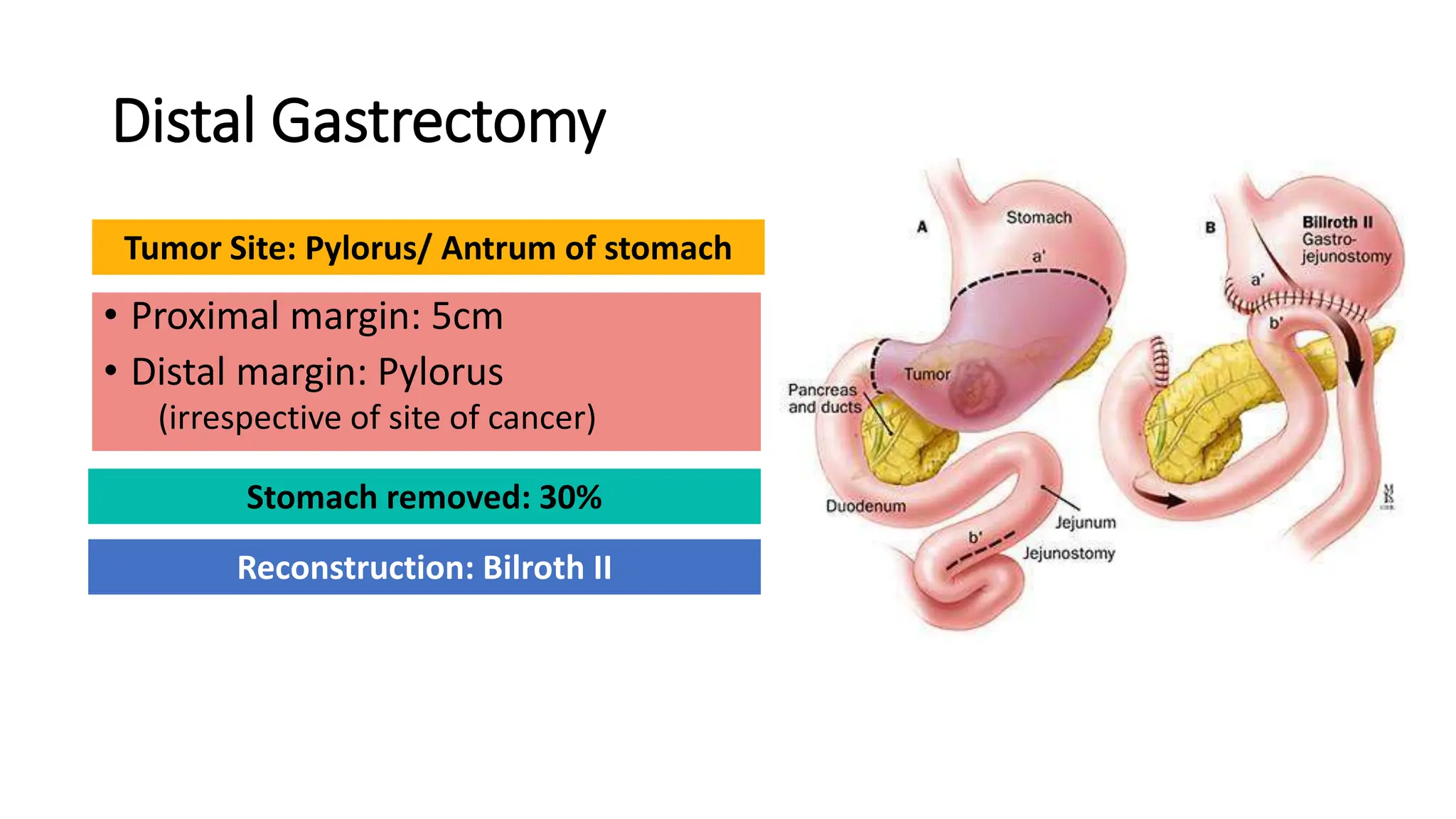 Stomach cancer | PPTX