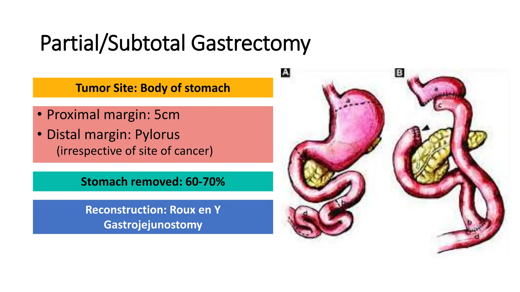 Stomach cancer | PPTX