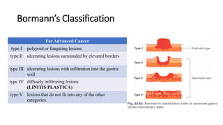 Stomach cancer | PPTX