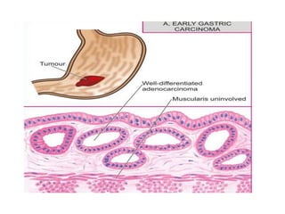 Carcinoma of stomach pathology. Ppt by | PDF