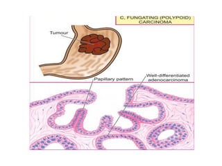 Carcinoma of stomach pathology. Ppt by | PDF