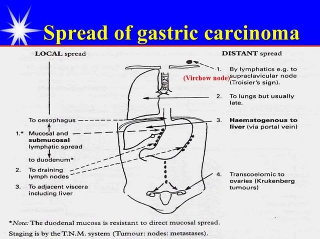Ca stomach | PPT