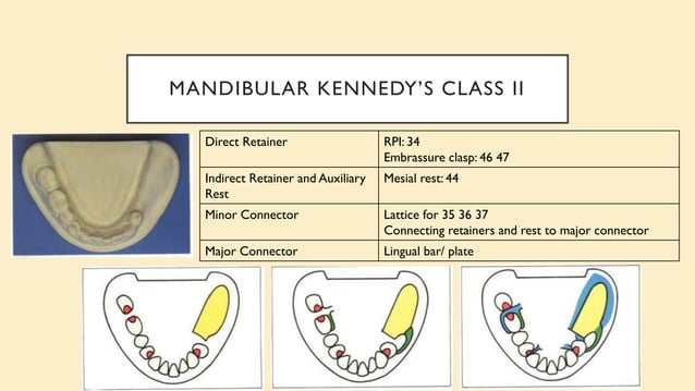 Cast partial denture design | PDF | Dental Health | Diseases and Conditions