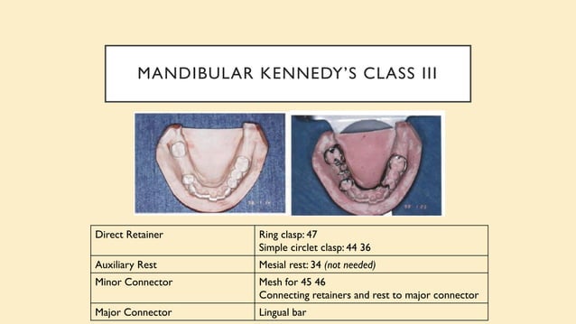 Cast partial denture design | PDF | Dental Health | Diseases and Conditions