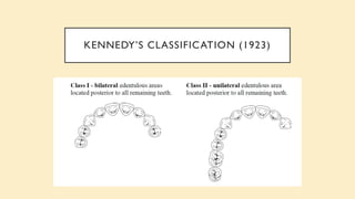 Cast partial denture design | PPT