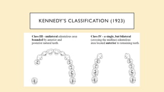 Cast partial denture design | PPT