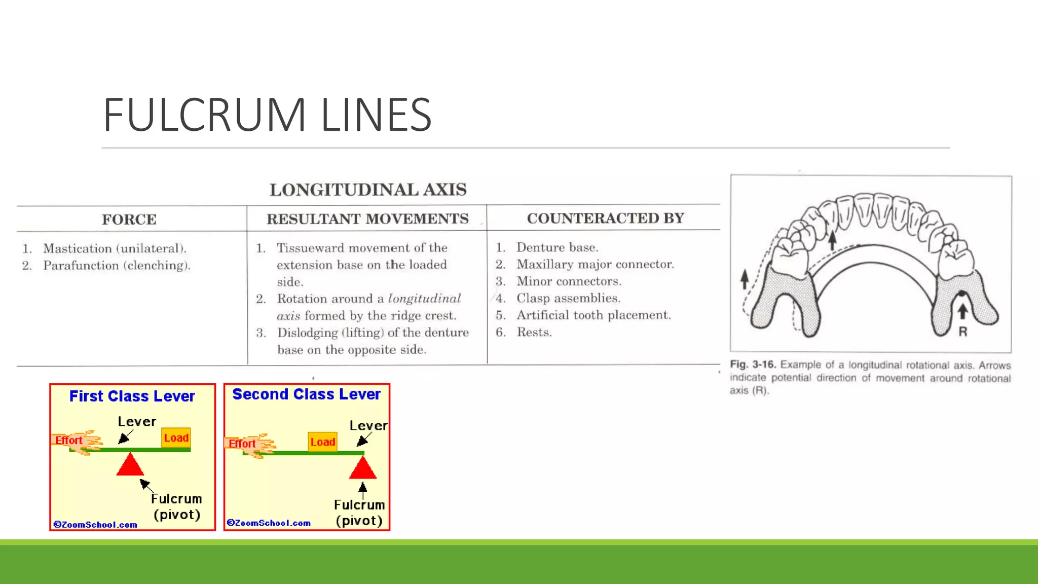 BASIC PRINCIPLES AND FUNDAMENTALS OF CAST PARTIAL DENTURE DESIGNING | PPTX