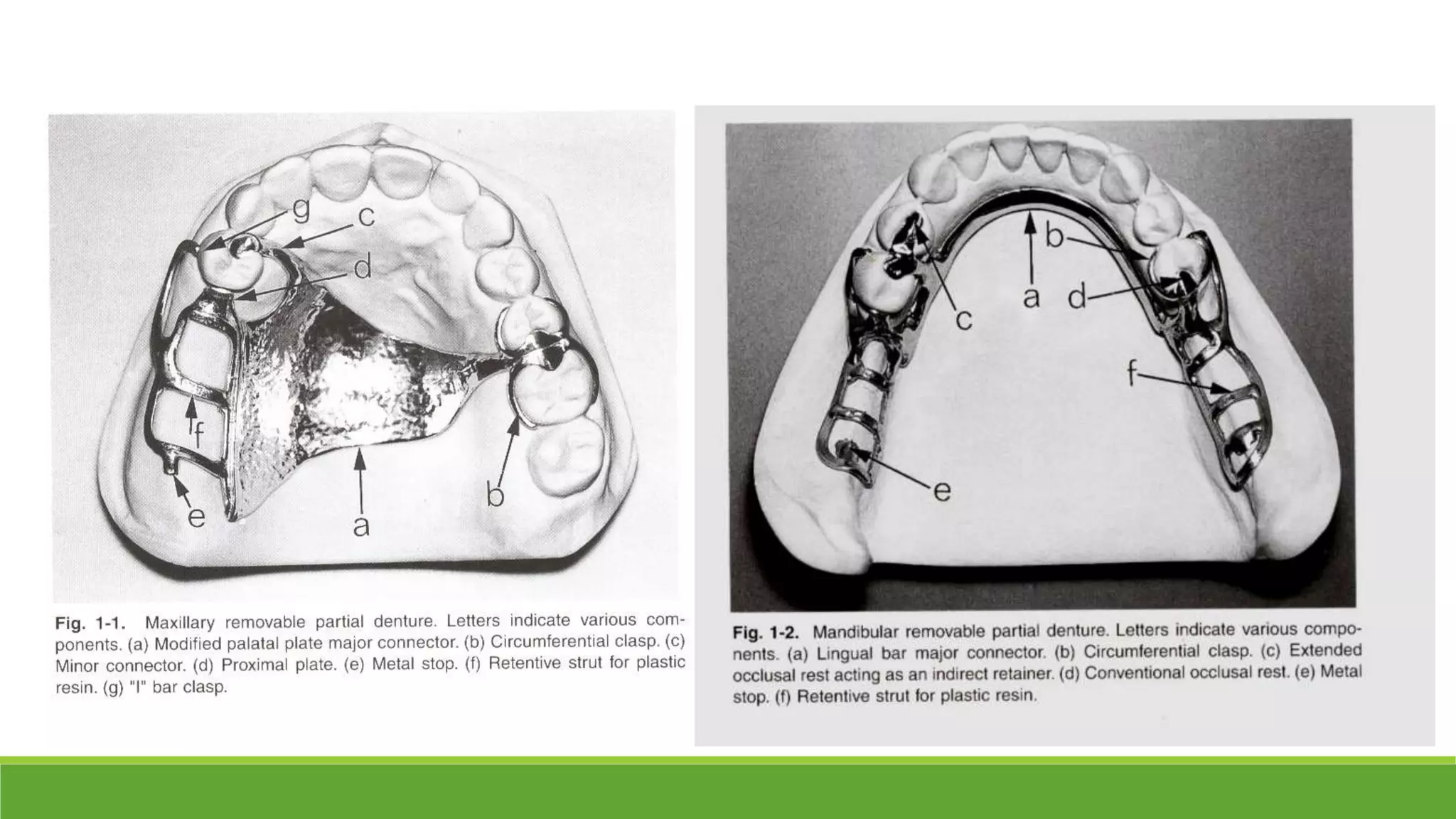BASIC PRINCIPLES AND FUNDAMENTALS OF CAST PARTIAL DENTURE DESIGNING | PPTX