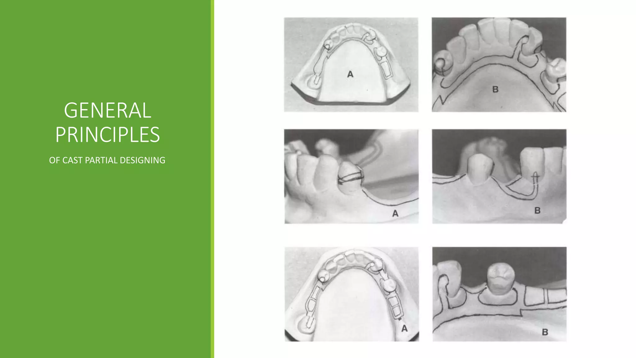 BASIC PRINCIPLES AND FUNDAMENTALS OF CAST PARTIAL DENTURE DESIGNING | PPTX