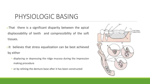 BASIC PRINCIPLES AND FUNDAMENTALS OF CAST PARTIAL DENTURE DESIGNING | PPTX