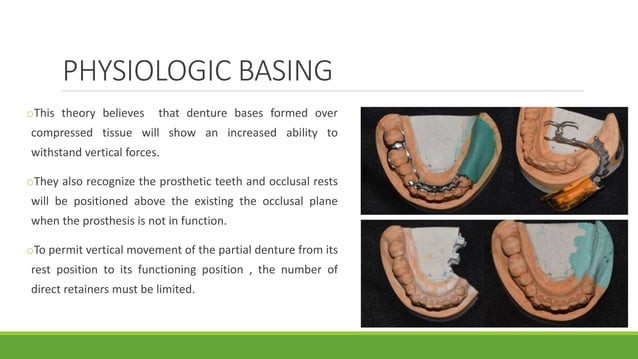 BASIC PRINCIPLES AND FUNDAMENTALS OF CAST PARTIAL DENTURE DESIGNING | PPTX