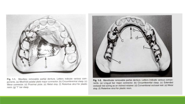BASIC PRINCIPLES AND FUNDAMENTALS OF CAST PARTIAL DENTURE DESIGNING | PPTX
