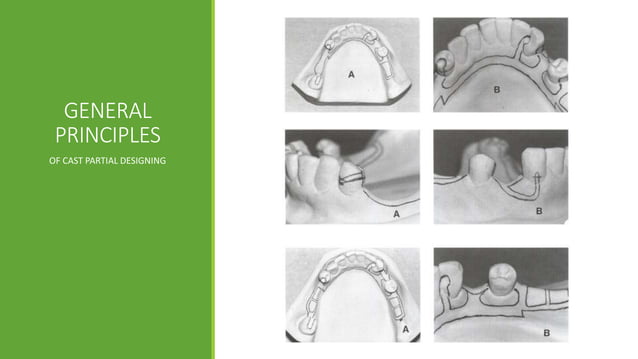 BASIC PRINCIPLES AND FUNDAMENTALS OF CAST PARTIAL DENTURE DESIGNING | PPTX