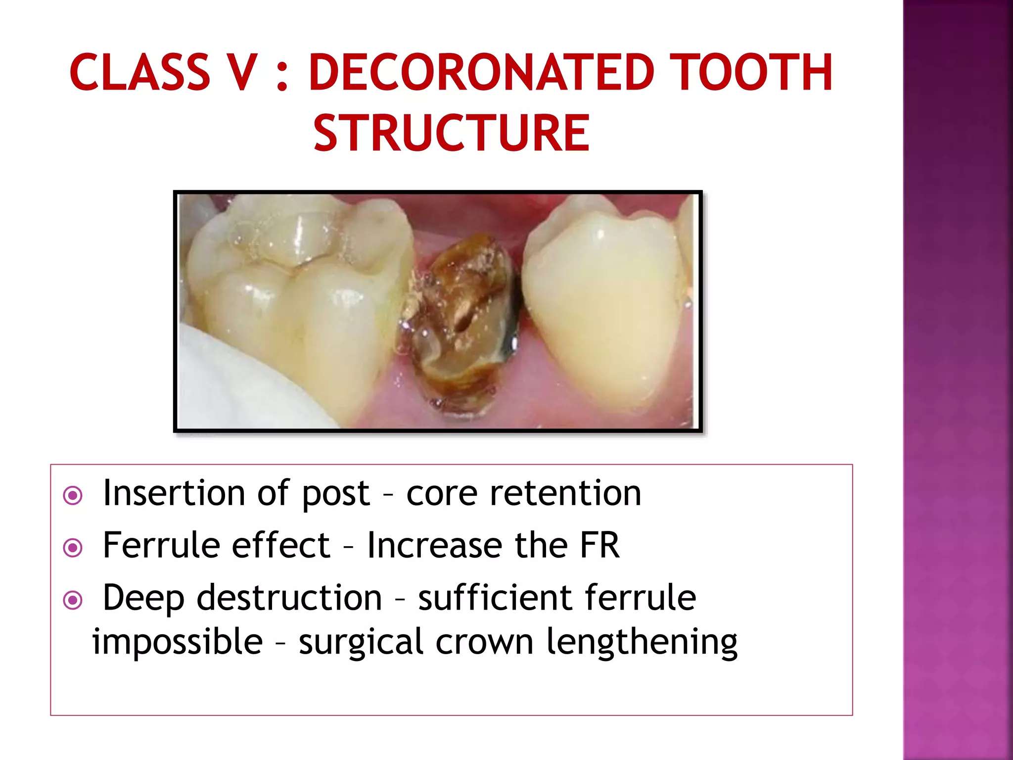 Cast post - Restoration of endodontically treated teeth | PPTX | Dental ...