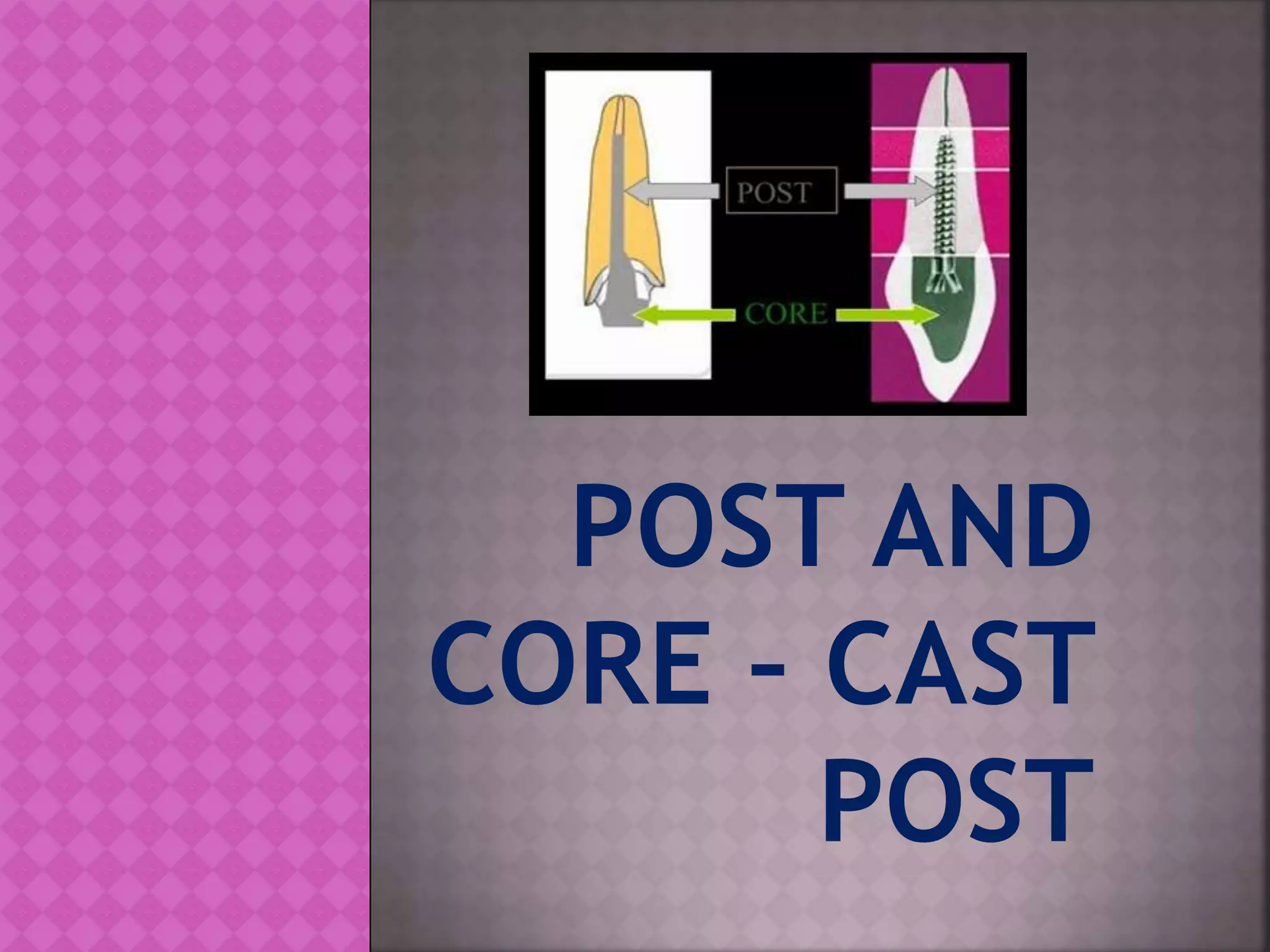 Cast post - Restoration of endodontically treated teeth | PPTX