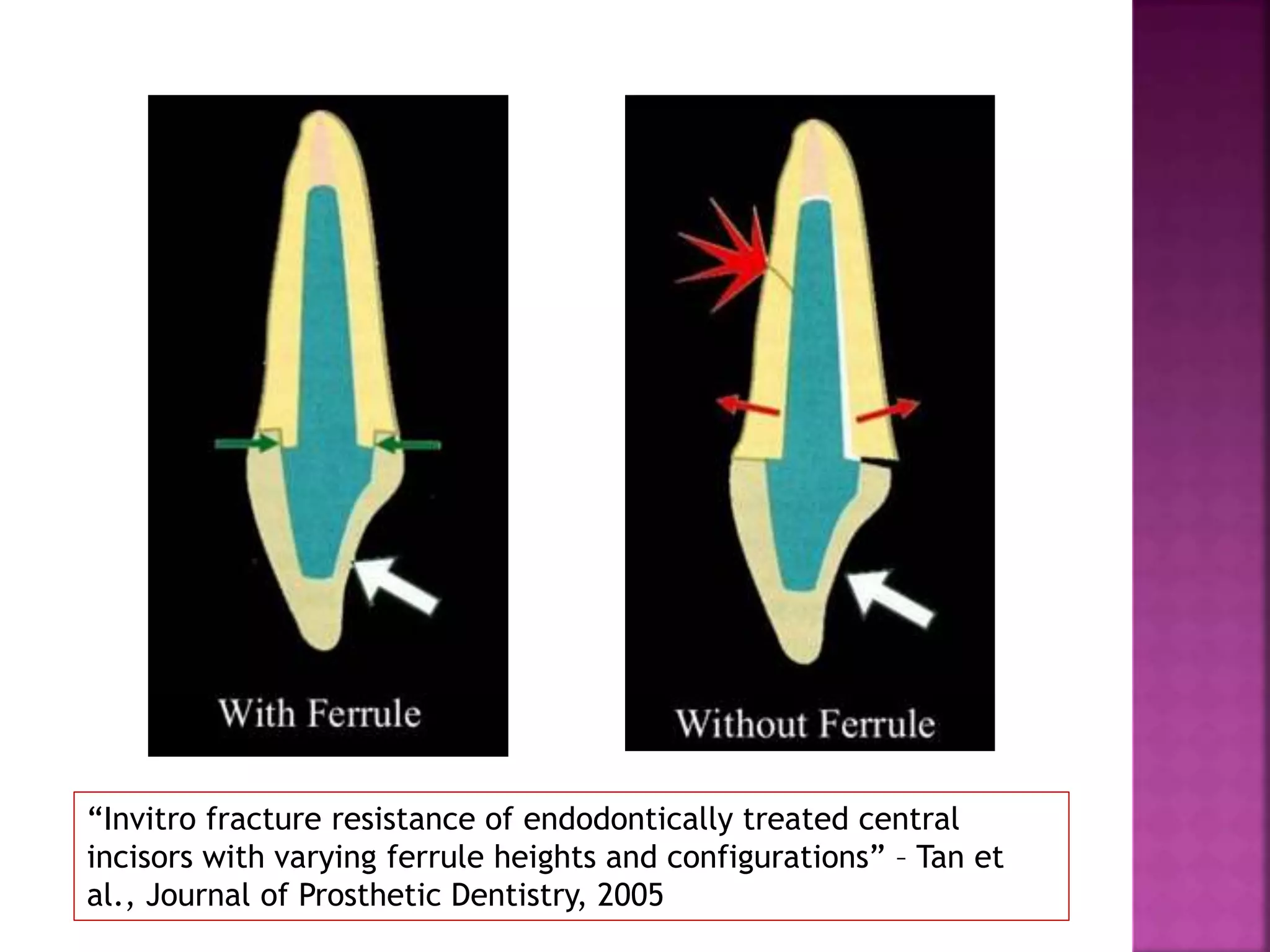 Cast post - Restoration of endodontically treated teeth | PPTX | Dental ...