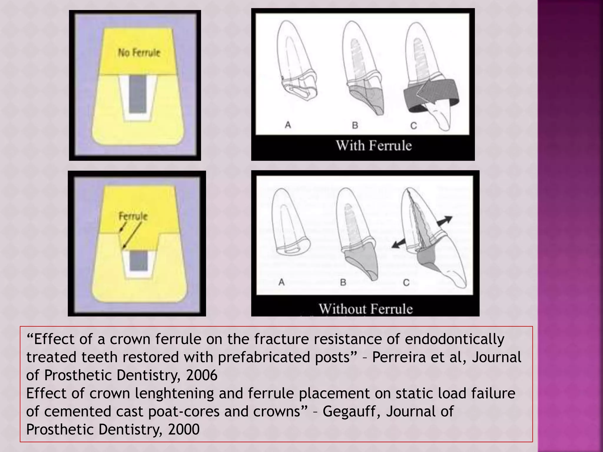 Cast post - Restoration of endodontically treated teeth | PPTX | Dental ...