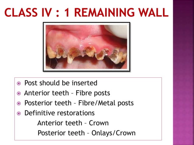 Cast post - Restoration of endodontically treated teeth | PPTX | Dental ...
