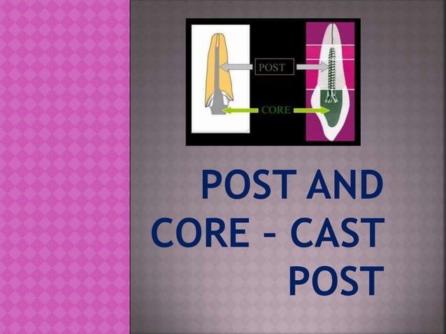 Cast post - Restoration of endodontically treated teeth | PPTX | Dental ...
