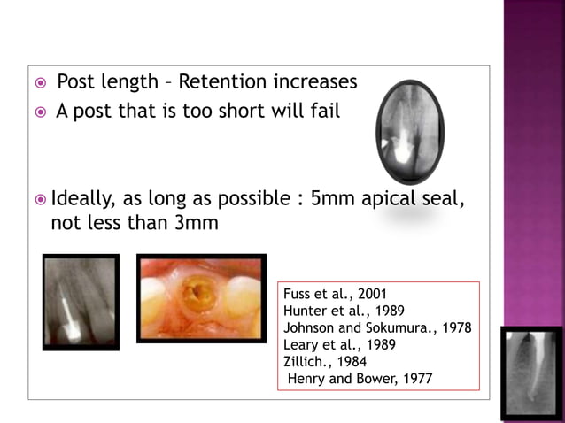 Cast post - Restoration of endodontically treated teeth | PPTX | Dental ...