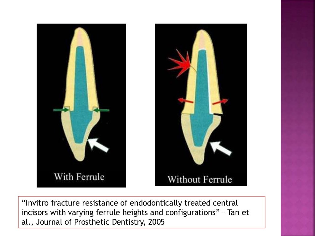 Cast post - Restoration of endodontically treated teeth