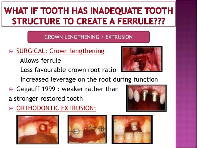 Cast post - Restoration of endodontically treated teeth