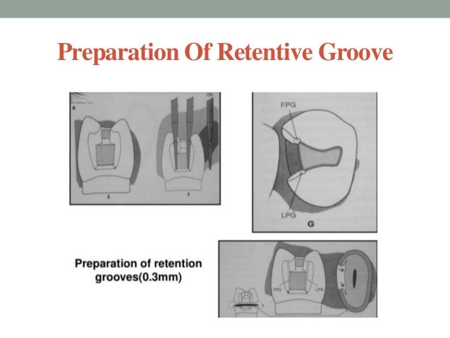 Cavity preparation for cast metal restorations