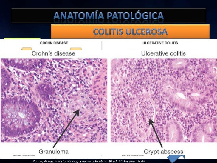 Enfermedad Inflamatoria Intestinal (Enf. Crohn y colitis ulcerosa)