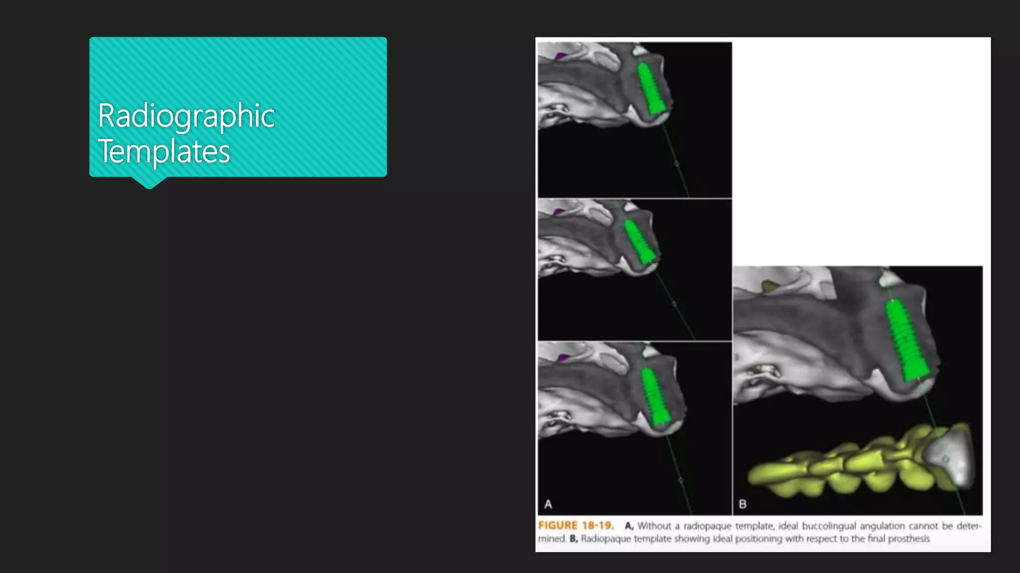 Diagnostic Casts,surgical templates and provisionalization | PPTX