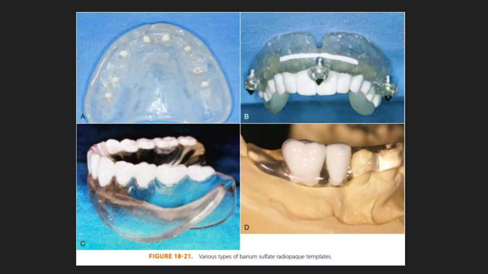Diagnostic Casts,surgical templates and provisionalization | PPTX