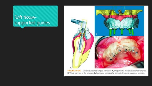 Diagnostic Casts,surgical templates and provisionalization | PPTX