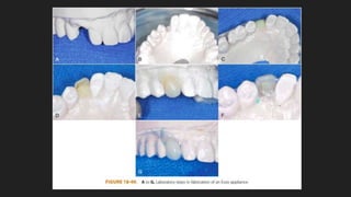 Diagnostic Casts,surgical templates and provisionalization | PPTX