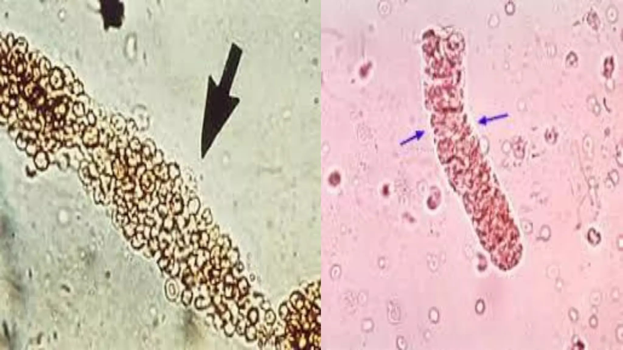 Casts in urine - Routine | PDF