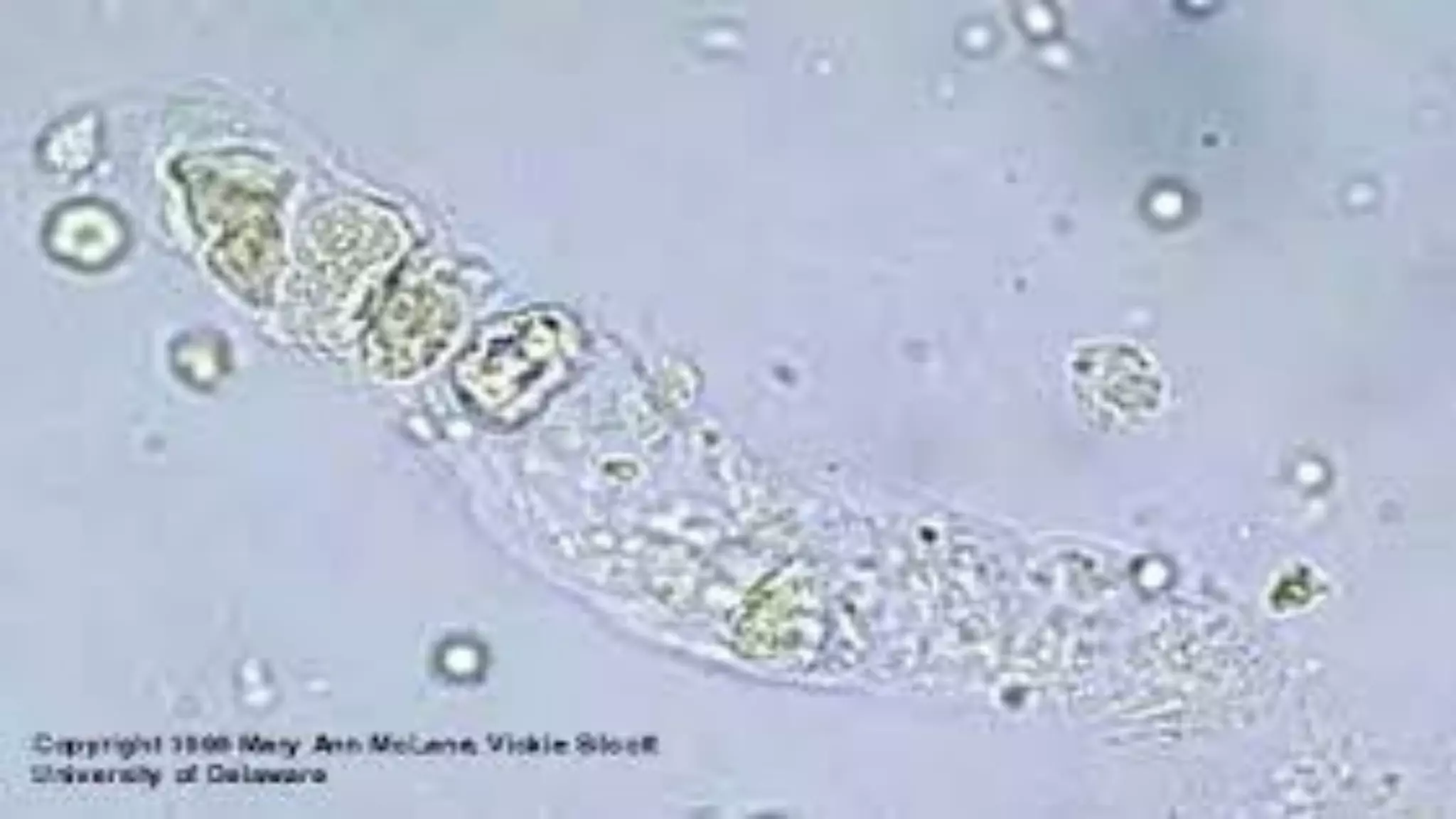 Casts in urine - Routine | PDF