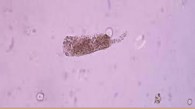 Casts in urine - Routine | PDF