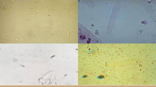 Casts in urine - Routine | PDF