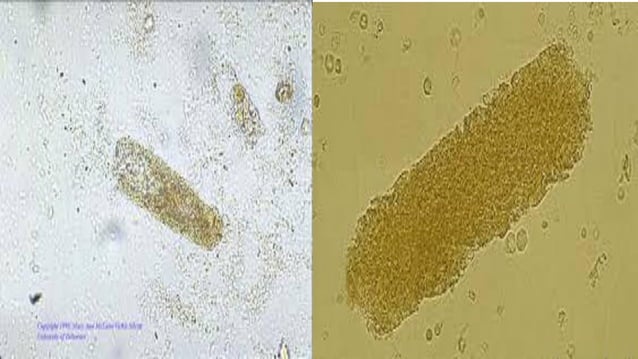 Casts in urine - Routine | PDF