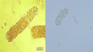 Casts in urine - Routine | PDF