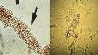 Casts in urine - Routine | PDF