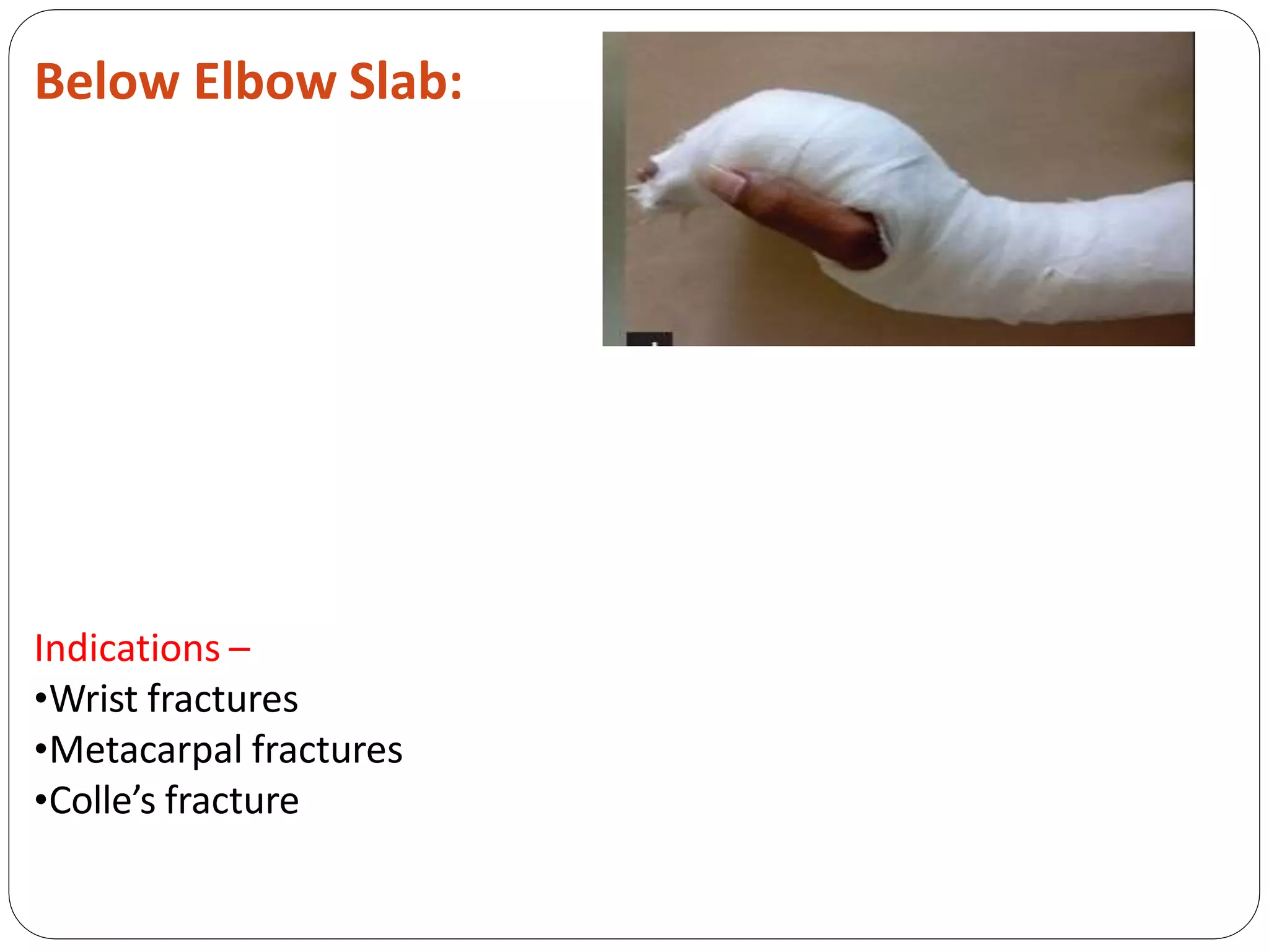 POP PLASTER AND CAST TECHNIQUES | PPTX