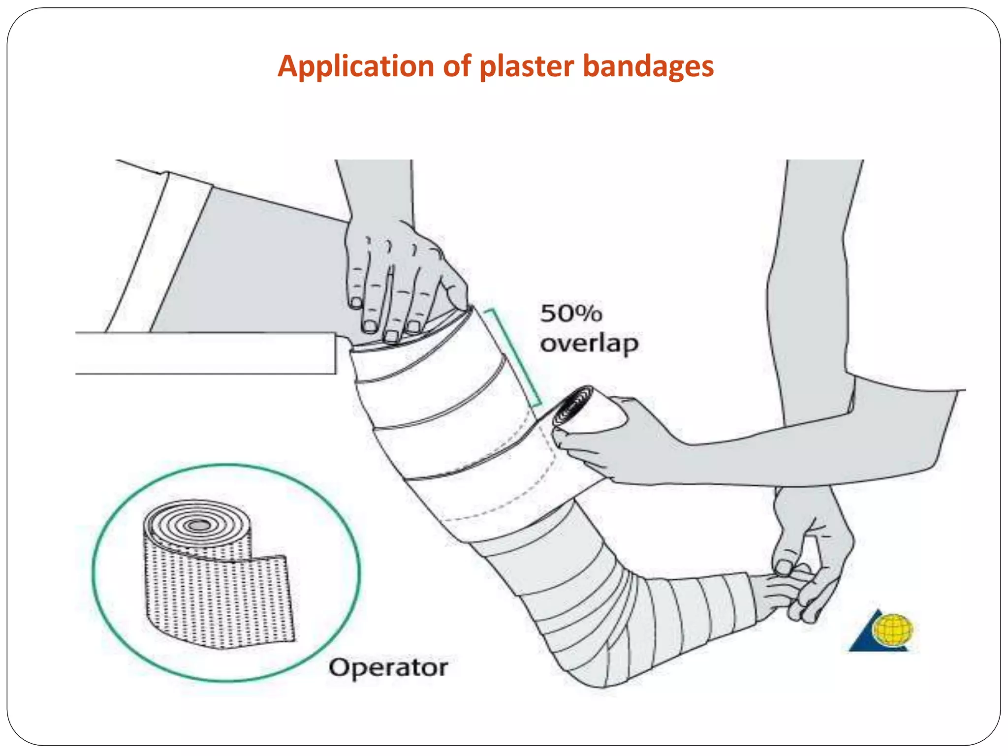 POP PLASTER AND CAST TECHNIQUES | PPTX