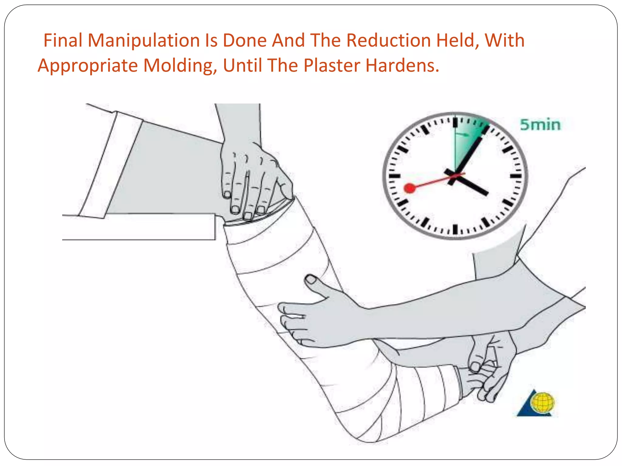 POP PLASTER AND CAST TECHNIQUES | PPTX