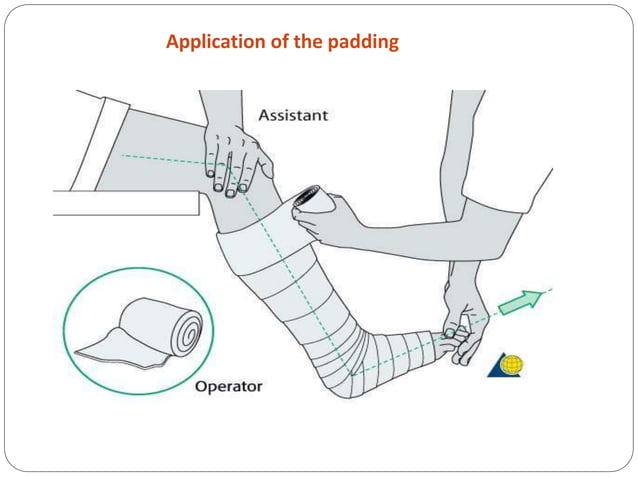 POP PLASTER AND CAST TECHNIQUES | PPTX | First Aid | Injuries
