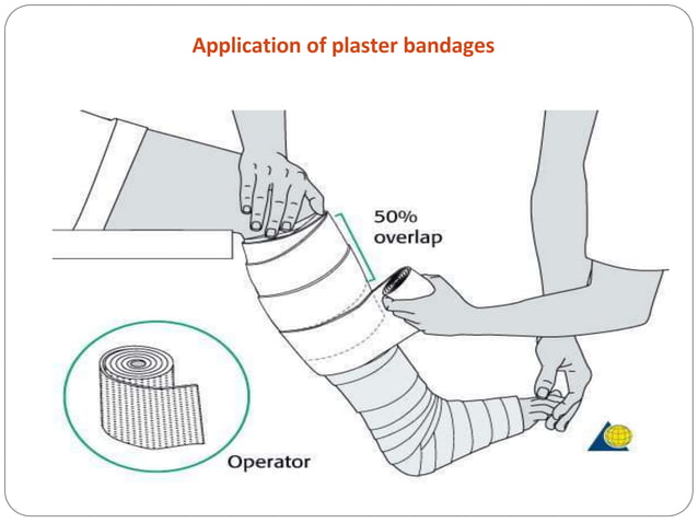 POP PLASTER AND CAST TECHNIQUES | PPTX | First Aid | Injuries